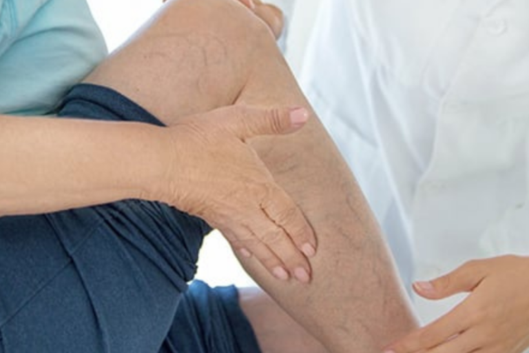 Vein Treatment Center St Louis - Vein & Lymphatic Doctor