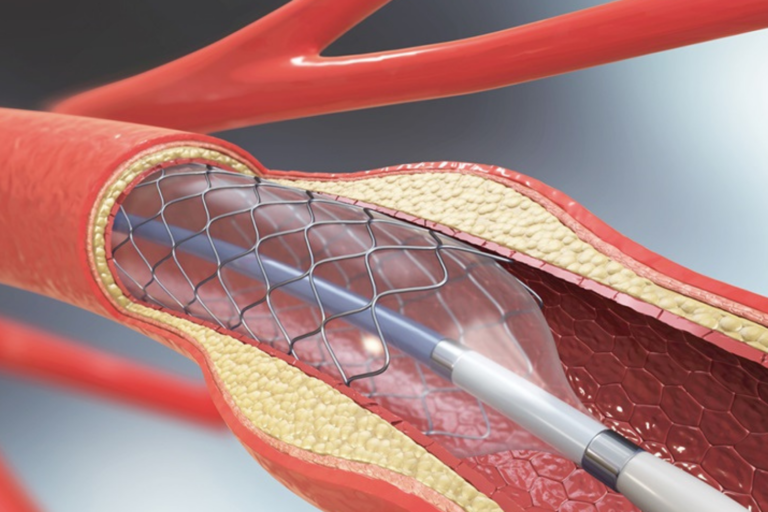 Vein Treatment Center St Louis - Vein & Lymphatic Doctor