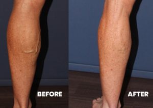 Ambulatory Phlebectomy Treatment - Virtue Vein & Lymphatic Center